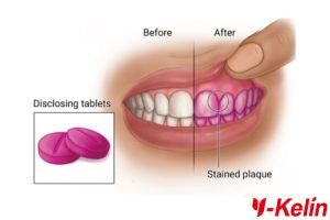 Are Plaque Disclosing Tablets Safe? - ITS Dental